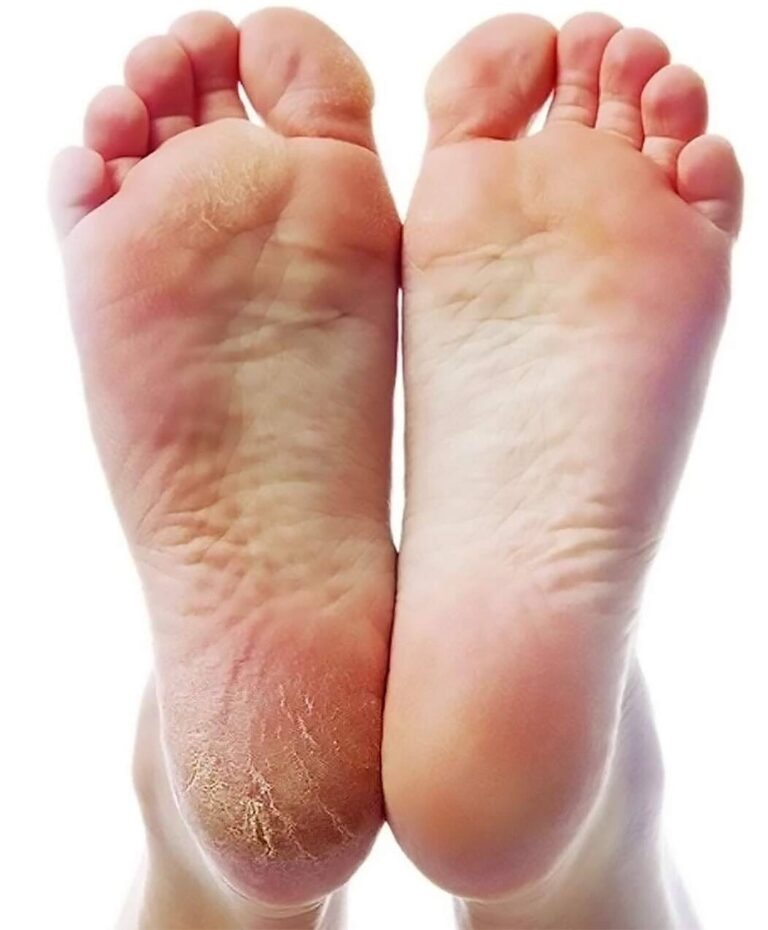 Highly Rated Callus Remover Gel Just $6.28 (+ Foot Care Socks Just $6.98)